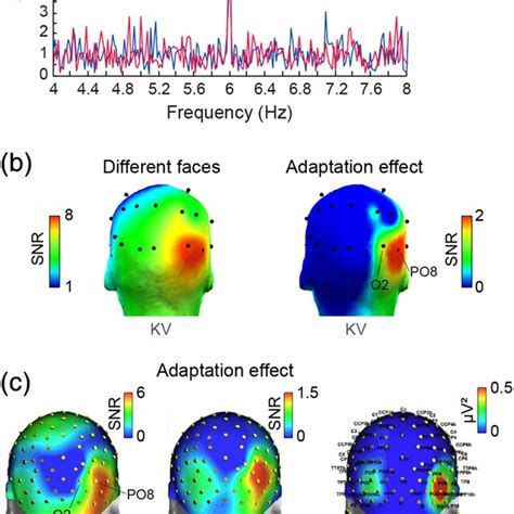 Simultaneous Recording Of Scalp And Intracerebral Eeg A Scalp View Download Scientific