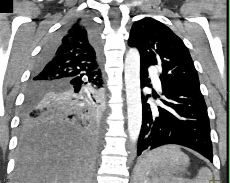 Large Pulmonary Embolism