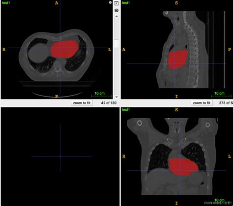 Dicom Rt Struct在python中显示mask以及使用3d Slicer转换为nii吨吨不打野的博客 Csdn博客