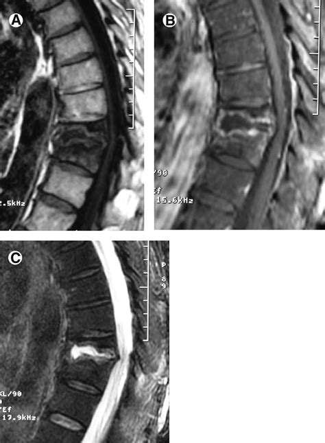 Osteoporotic Compression Fracture At T10 And T11 Vertebrae In A Download Scientific Diagram
