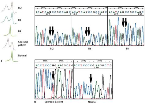 Dhplc Analysis A And Sequence Analysis B Of Pcr Products Of Pax9