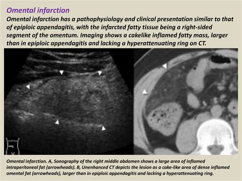 Presentation1 Pptx Ultrasound Examination Of The Appendix Pptx