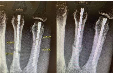 Screw Size May Impact Radiographic Displacement After Metacarpal