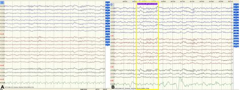 EEG Showing Sleep Like Pattern A With No Response To External Stimuli Download Scientific