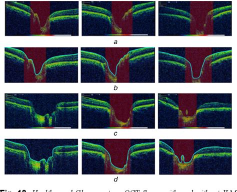 Figure 1 From Automated Glaucoma Detection Using Retinal Layers Segmentation And Optic Cup To