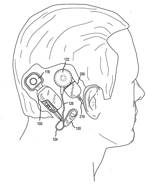 Behind The Ear Hearing Aids Patented Technology Retrieval Search