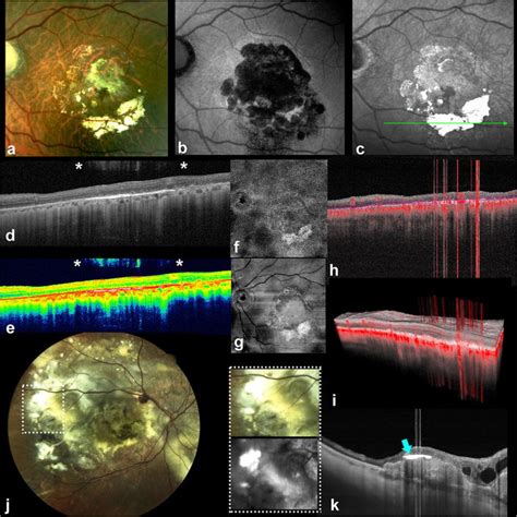 Three Dimensional 3d Swept Source Optical Coherence Tomography