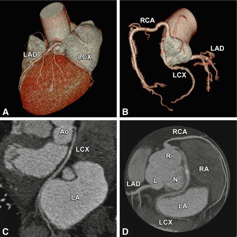 Coronary Artery Anomalies Radiology Key