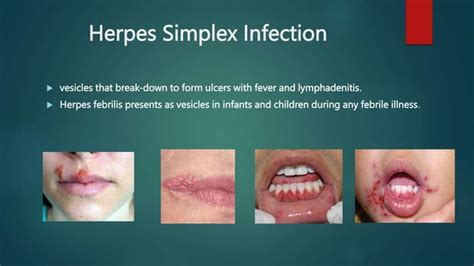 Ahmed Al Abbasi Oral Cavity And Tongue Diseases Pptx