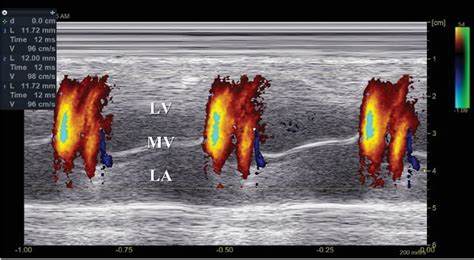 Figure 2 From Assessment Of Diastolic Function Using Mitral Flow