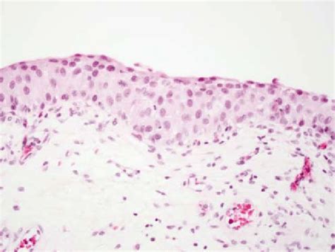 Urothelial Dysplasia There Is Mild Nuclear Enlargement With A Somewhat