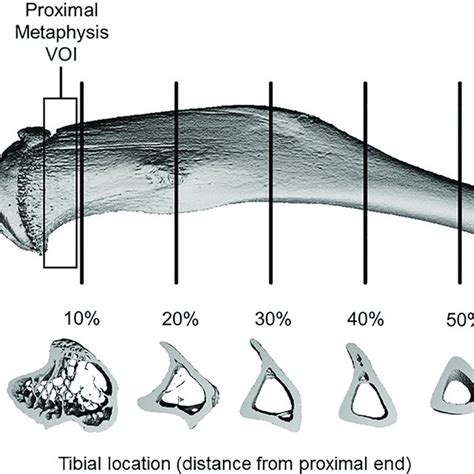 Trabecular Bone Parameters Assessed At The Tibial Metaphysis Using