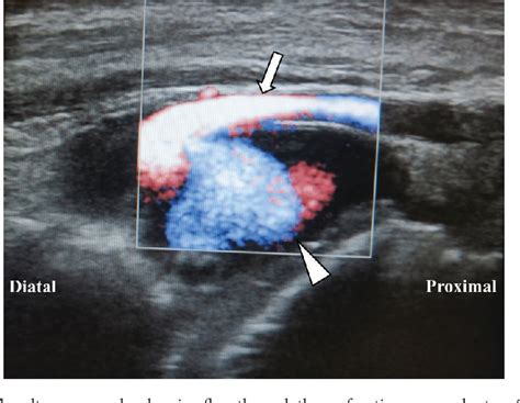 Figure 4 From Pseudoaneurysm Of The Perforating Peroneal Artery Following Ankle Arthroscopy