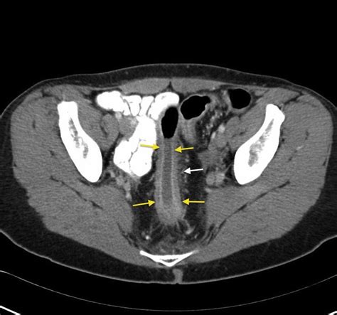 Proctitis CT Radiology At St Vincent S University Hospital
