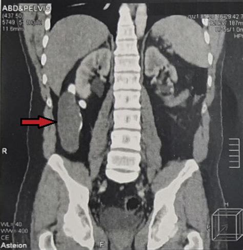 Giant Mucocele Of The Appendix Surgery