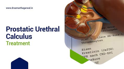 Prostatic Urethral Calculus Treatment Dr Samarth Agarwal