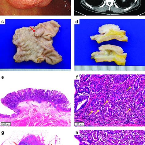 Endoscopic Radiologic And Pathologic Findings Of Case 2 A