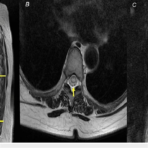 T2 Flair And Dwi With Dsa For Davf With Venous Reflux Located In The
