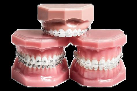 Damon Braces In North London Free Consultation Hampstead