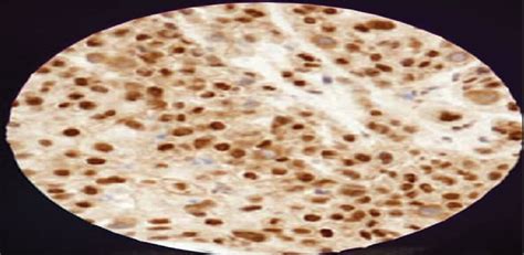 Does P16 Protein Expression Affect Treatment Prognosis In Or Annals Of Maxillofacial Surgery