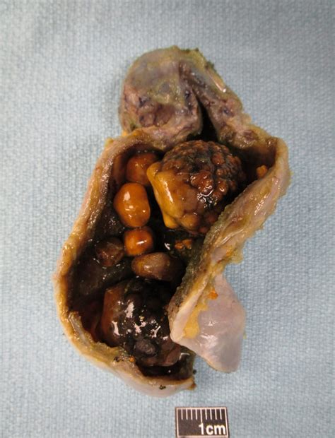 Chronic Cholecystitis Gross