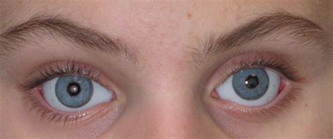 Bilateral Congenital Microphthalmia With Visual Acuity Dalpasso