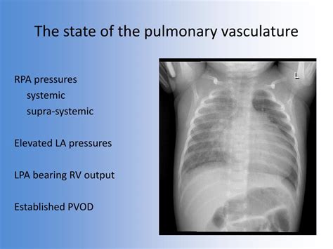 Ppt Assessment Of Pulmonary Vascular Resistance Powerpoint