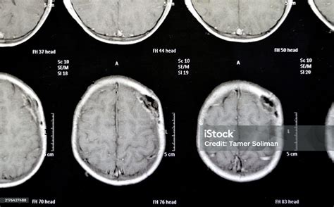 Mri Of The Brain Reveals Previous Shunt Operations For A Hydrocephalus