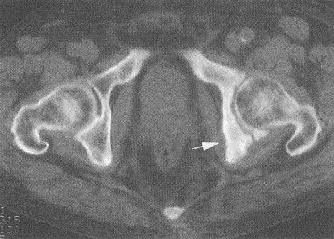 例1 前列腺癌 Ct读片指南 医学
