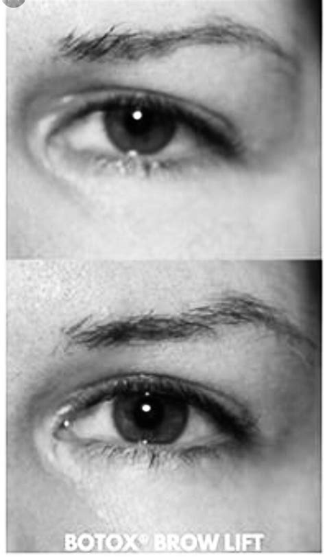 Kelopak Mata Turun Botox Atau Blepharoplasty Klinik Bedah Plastik Queen