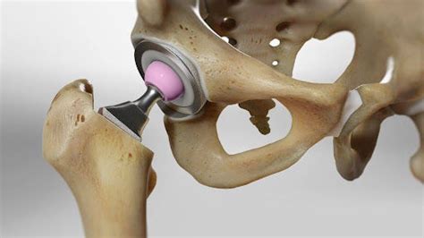 Avoiding Total Hip Replacement Exploring Conservative And Surgical