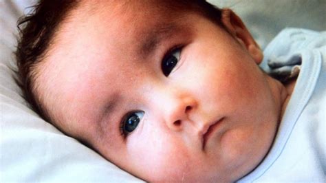 Prader Willi Syndrome Infant