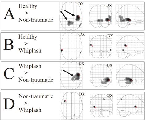 Maximum Intensity Projections Mip Of Regions With Differences In Rcbf Download Scientific