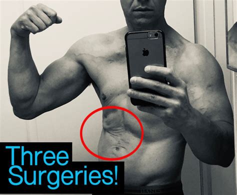 How Long Does It Take To Get Abs Cancer Survivorship Tips From Survivor Ryan Hamner