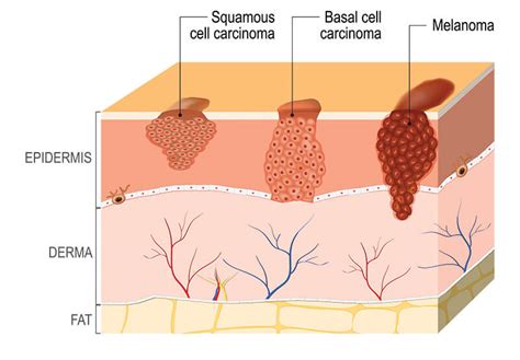 Basal And Squamous Cell Skin Cancer Spread