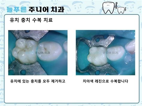 소아 충치 치료 수원 호매실 늘푸른주니어치과