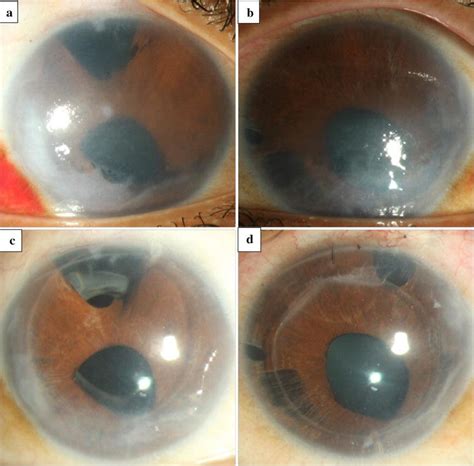 a d diffuse illumination slit lamp images showing pre operative views
