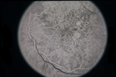 Ocular Ischemia Retina Image Bank
