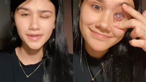 Jovem Perde Visão De Um Olho Por Conta Das Lentes De Contato