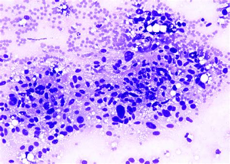 Pleomorphic Liposarcoma This Aggregate Shows Obvious Anisonucleosis