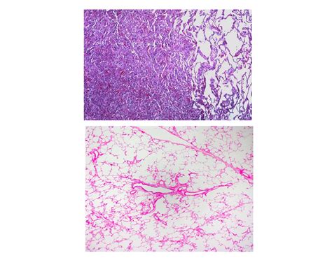 Lung Tissue With Atelectasis Quiz