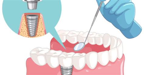 Are Dental Implants A Permanent Solution For Missing Teeth Wise Dental