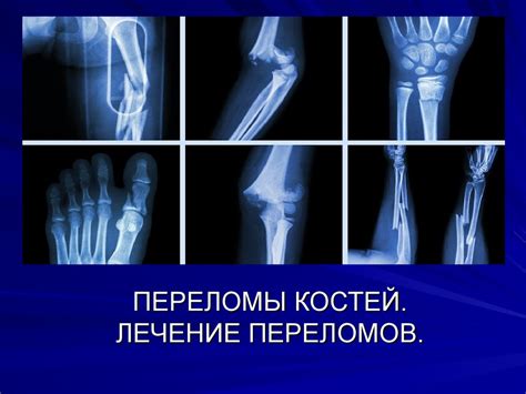 Переломы костей. Лечение переломов - презентация онлайн