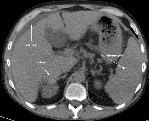 How Long Ct Scan Hutomo