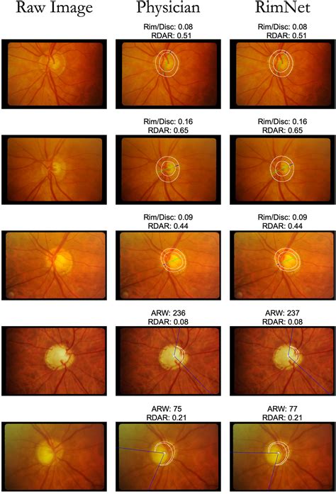 Rimnet A Deep Neural Network Pipeline For Automated Identification Of The Optic Disc Rim