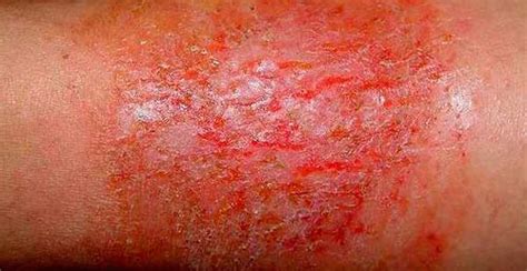 Дерматит причины симптомы лечение виды фото У Гиппократа