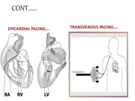 Pin By Nonas Arc On Epicardial Pacing Wires Rv Nurse
