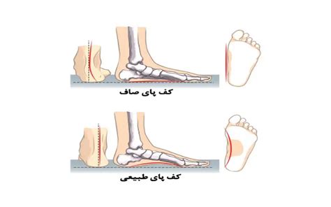 صافی کف پا Flat Feet بدن خوبا