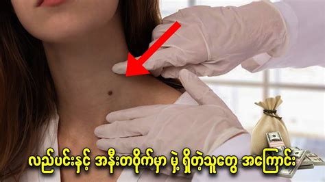 လည်ပင်းနှင့် အနီးတဝိုက်မှာ မှဲ့ ရှိတဲ့သူတွေ အကြောင်း Youtube