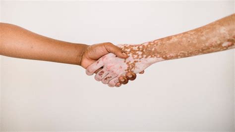 ¿cuáles Son Las Causas Del Vitiligo